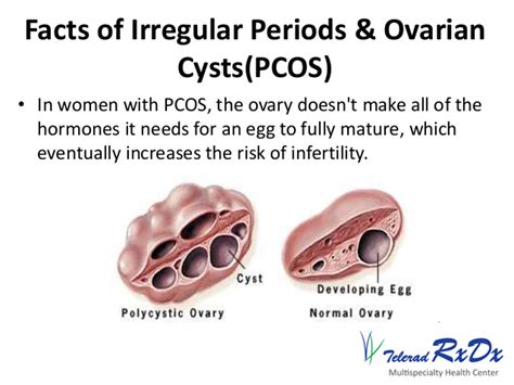 Think You Have Pcos Understand Pcos Risks Symptoms And Complications