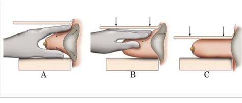 Can You Have A Mammogram With Breast Implants