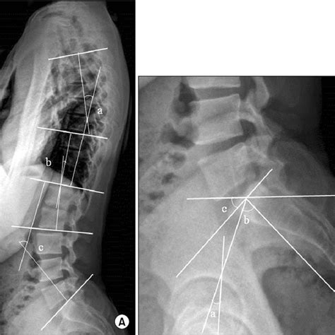 Spinal And Pelvic Parameters A Spinal Parameters Including Thoracic