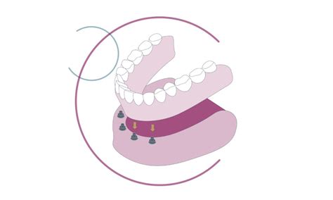 Implant Secured Dentures