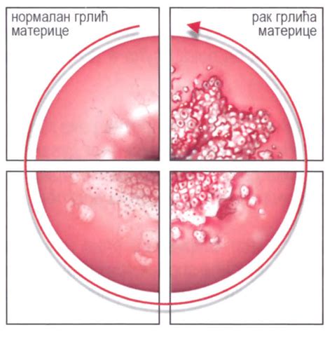 Kancer Grlića Materice Jedna Od Najčešćih Malignih Bolesti žena Kancer