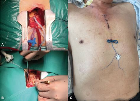 The Mini Sternotomy Av Replacement Procedure A The Pericardium Was Download Scientific