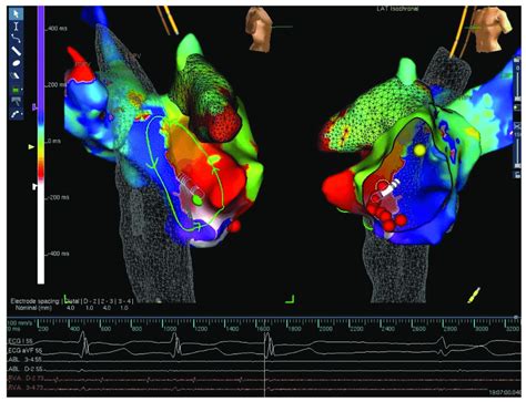 Three Dimensional Electroanatomical Mapping Of A Patient With Single Download Scientific