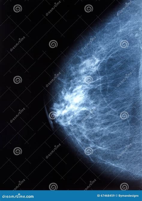 X Ray Image Of Breast Mammogram Woman Stock Image Image Of Examination Anatomy