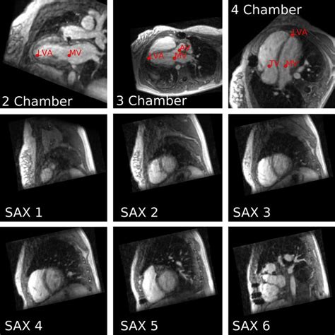 Cardiac Views Results For A 3d Cine Single Breath Hold Mri Left 4 Download Scientific Diagram