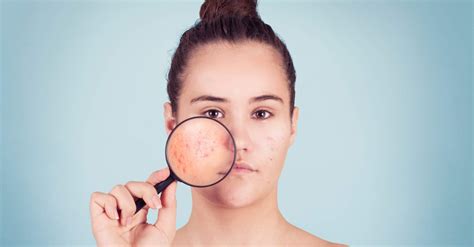 Hormonal Acne What It Is How To Treat It Effectively