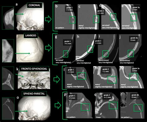Spectrum Of Suture Patterns 3d Ct A F K O 2d Ct B C D E G