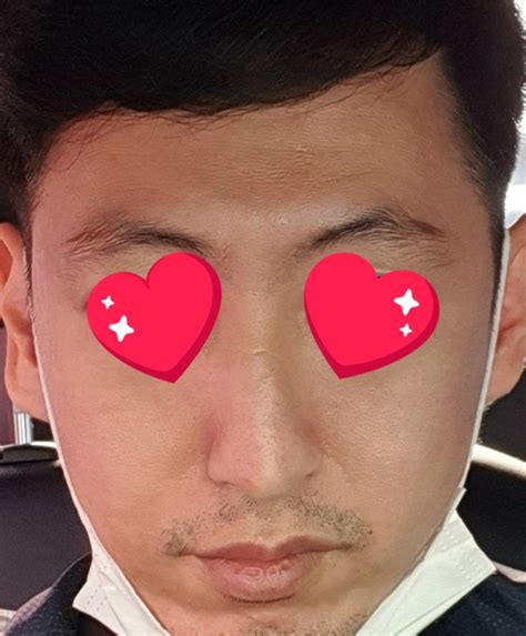 얼굴 피부 패인 흉터 치료문의 지식in