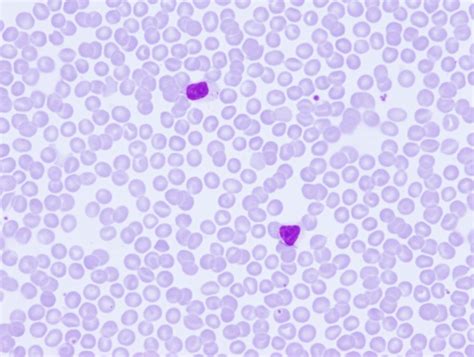 Large Granular Lymphocytes