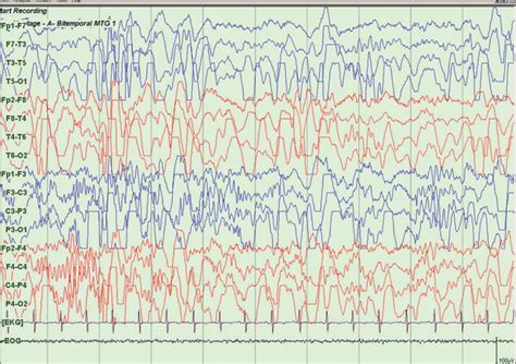 Journal Of Neurosciences In Rural Practice Current Issue