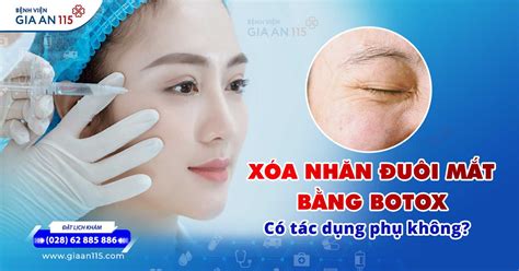 Xóa nhăn đuôi mắt bằng Botox có tác dụng phụ không?