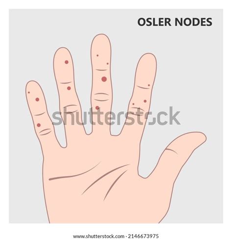 23개의 Osler Node 이미지 스톡 사진 3d 오브젝트 벡터 Shutterstock