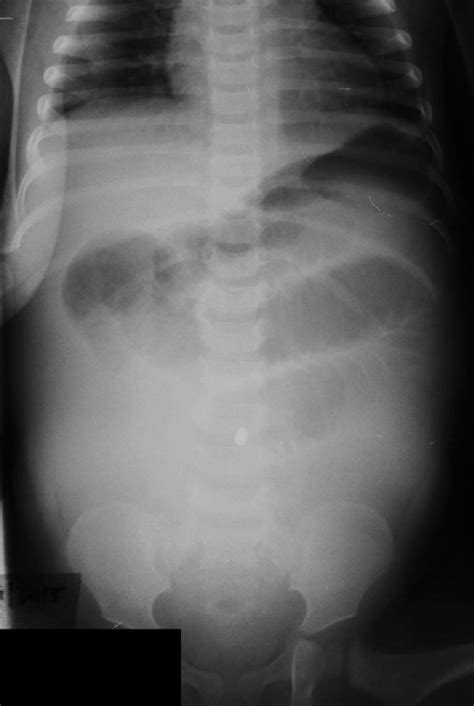 Abdominal Radiograph Repeated Five Hours Later Shows Persistently
