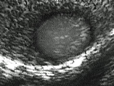 Ultrasound Showing Testicular Cancer Stock Image C0272338