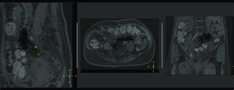 Diffusion Tensor Imaging Dti Reconstruction Of Transplanted Pancreas Download Scientific
