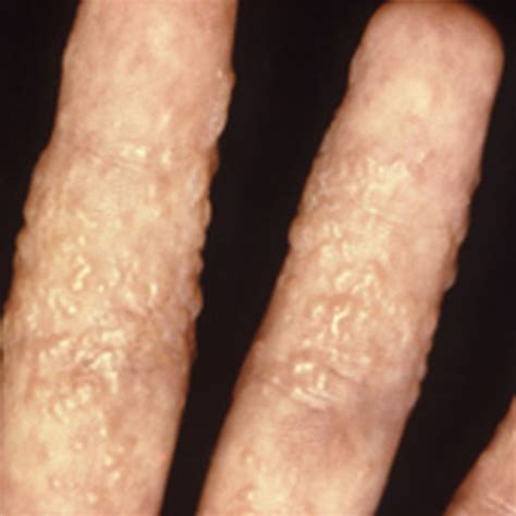Itchy Bumps Filled With Clear Liquid Causes And Treatment How To