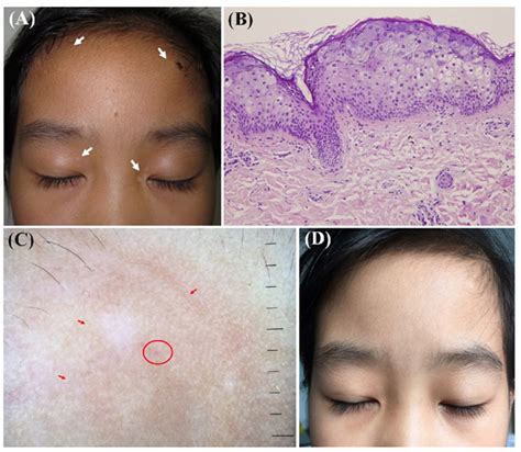 Tinea Versicolor Forehead