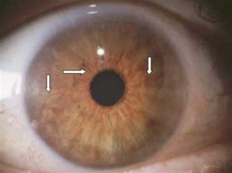 Neovascularization Of The Iris