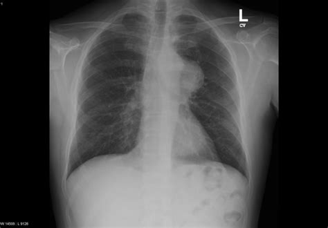 Left Hilar Lung Mass Radrounds Radiology Network