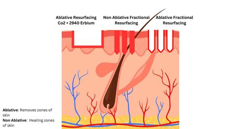 7 Eye Opening Differences Between Ablative Vs Non Ablative Lasers That