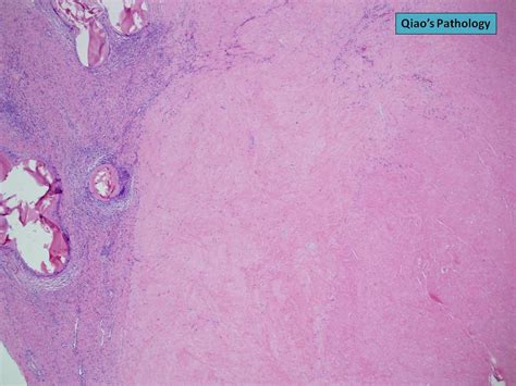 Qiao S Pathology Uterine Artery Embolization Of Leiomyoma Fibroid