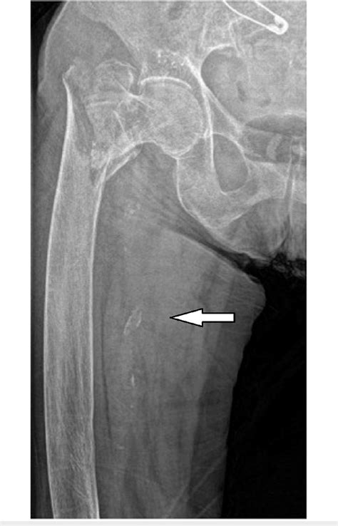 Radiographic Image Of The Intimal Type Femoral Artery Calcification