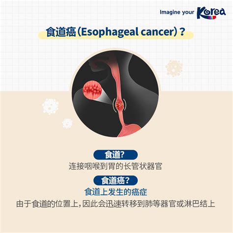 卡新闻 头颈部癌和食道癌 Visitkorea