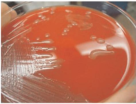 Figure 1 From An Update On Cryptococcus Among Hiv Infected Patients