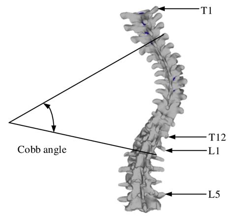 Schematic Diagram Of Cobb Angle Download Scientific Diagram