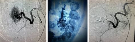 Vascular Anomalies And Malformations The Vascular Care Group