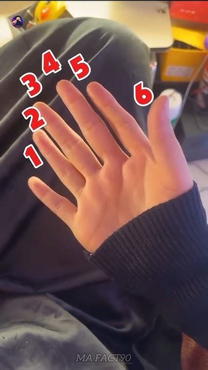 Polydactylysyndactyly😱shorts Facts Factsbangl Youtube
