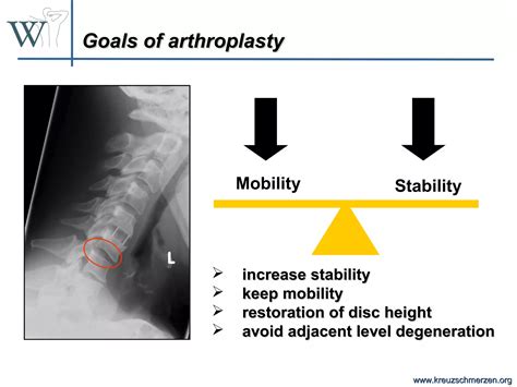 The Cervical Myelopathy Ppt