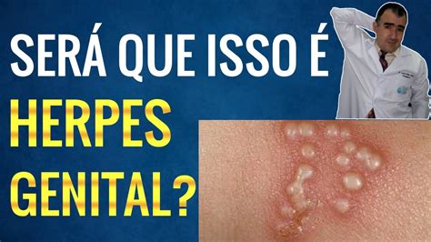Imagens De Herpes Genital RETOEDU