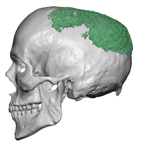 Bone Cement Skull Reconstruction 3d Ct Scan Side View Dr Barry Eppley Explore Plastic Surgery