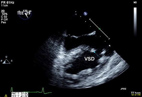 Transesophageal Echocardiogram Long Axis View Shows A Ventricular Download Scientific Diagram