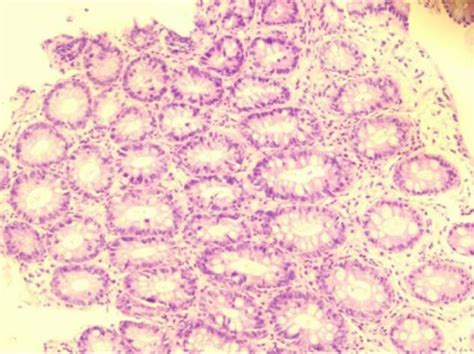 Biopsies Of Sigmoid Colon At Admission Revealed Focal Mucosal Chronic