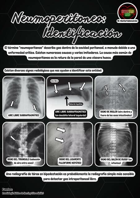 Neumoperitoneo Entertainmed Inc Udocz