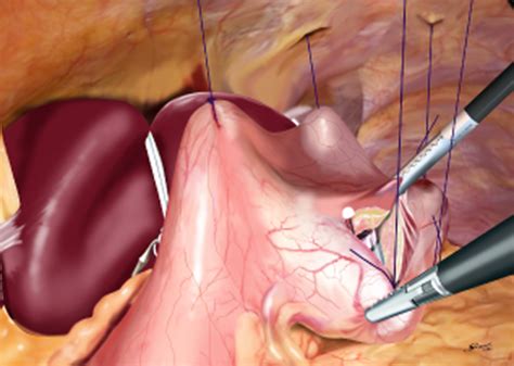 Laparoscopic Endoscopic Cooperative Surgery Hiki 2015 Digestive