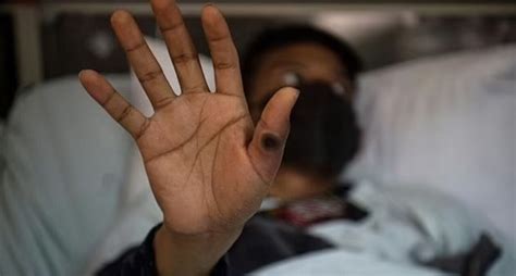 آبله میمونی یک تهدید جدی است اهمیت اقدامات پیشگیرانه خبرگزاری مهر اخبار ایران و جهان Mehr