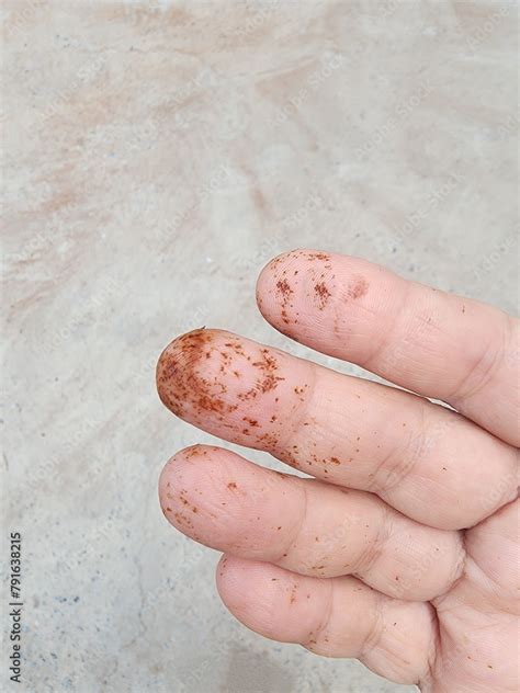 Brown Stains On Fingers Are Caused By Scales Of Potassium Permanganate