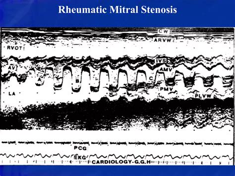 Echocardiographic Evaluation Of Mitral Valve Disease Pptx