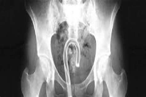 Ten Crazy And Strange Things Found Inside Peoples Bodies