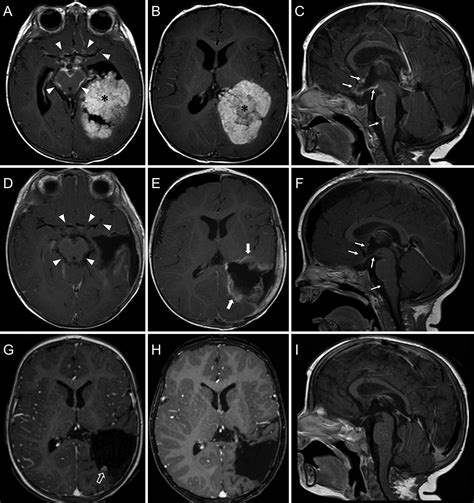 Choroid Plexus Carcinoma