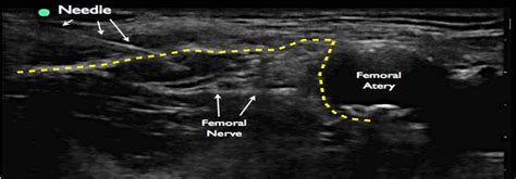 Fascia Iliaca Nerve Block