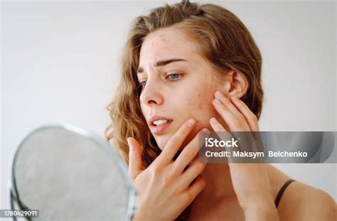 거울을 보고 손으로 얼굴을 만지는 아름다운 여성이 여드름 색소 침착을 검사합니다 여드름에 대한 스톡 사진 및 기타 이미지