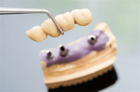 What Is The Bridge Sectioning Dental Code A Detailed Guide