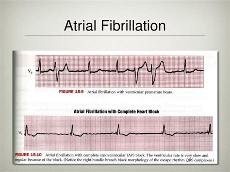 Ppt Atrial Flutter And Atrial Fibrillation Powerpoint Presentation