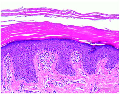 Ichthyosis Vulgaris Histology Acquired Ichthyosis With Systemic Lupus