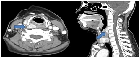 An Ectopic Parathyroid Adenoma Of The Retropharynx In A Patient With