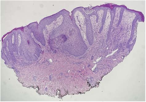 Successful Treatment Of Pyoderma Vegetans With Doxycycline Jaad Case Reports